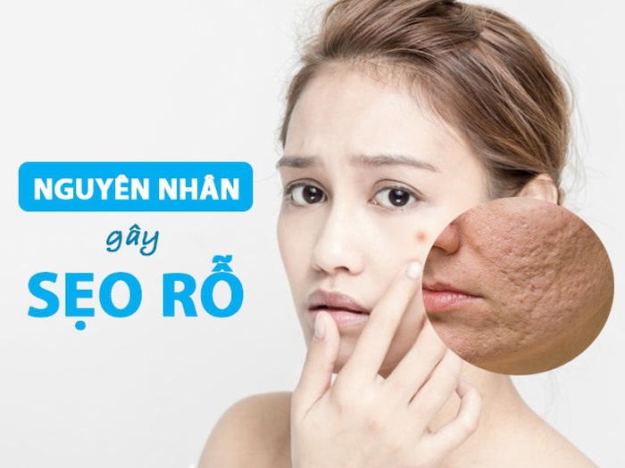 Biết được lý do da mặt sẹo rỗ, bạn sẽ không dám nặn mụn nữa » Báo Phụ ...