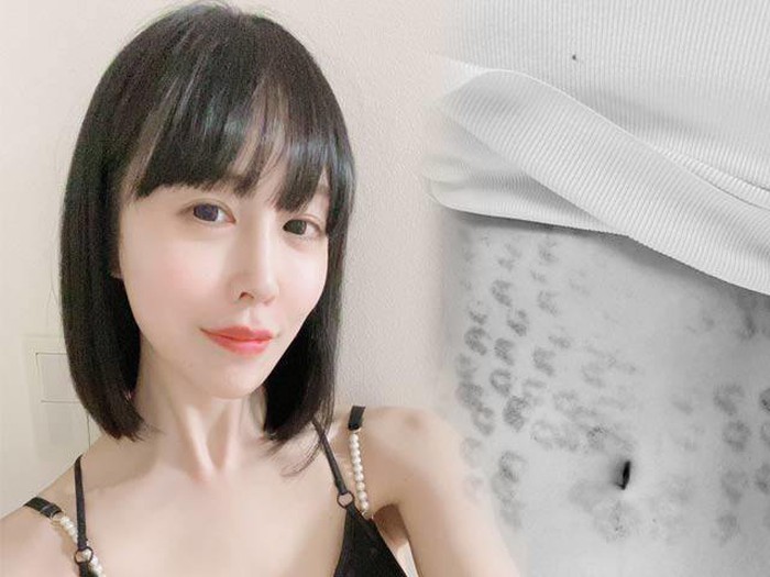 Nữ diễn viên Nhật Bản bị bỏng da khi đi... triệt lông vùng bụng » Báo Phụ Nữ Việt Nam