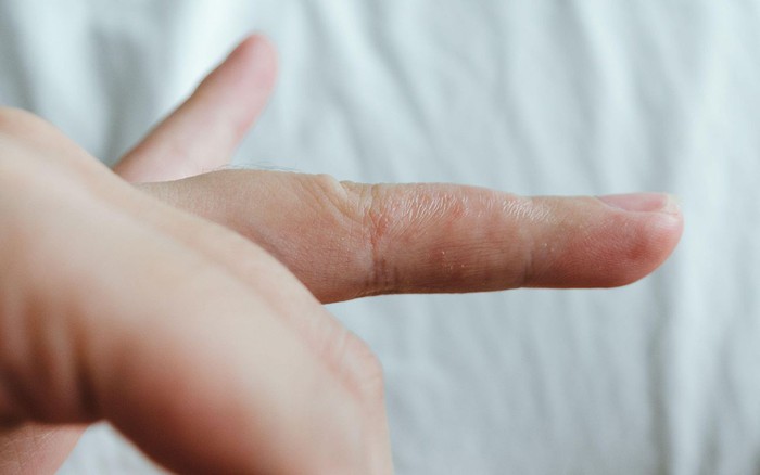 Tìm hiểu về bệnh chàm tổ đỉa gây gổi mụn nước ở tay » Báo Phụ Nữ Việt Nam